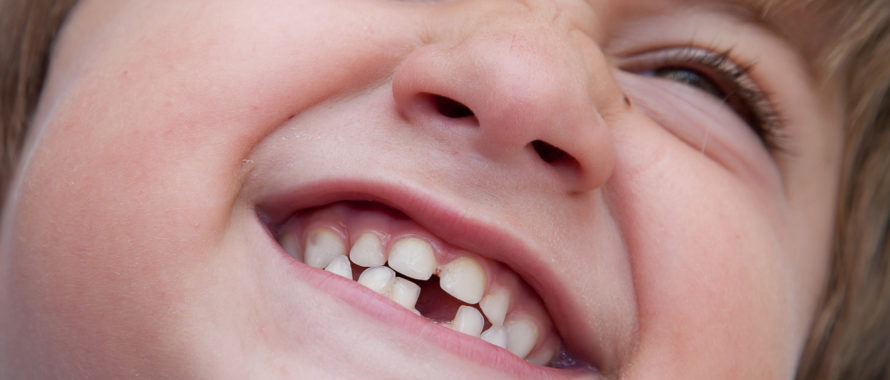 Caring for Your Children’s Teeth with Dental Sealants - Traceybell ...